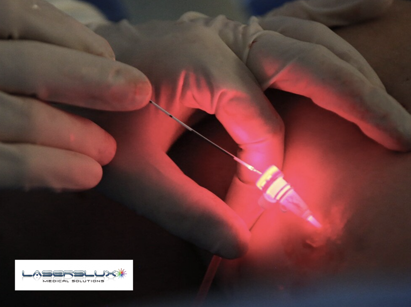 EVLT - TRATAMIENTO LASER ENDOVASCULAR