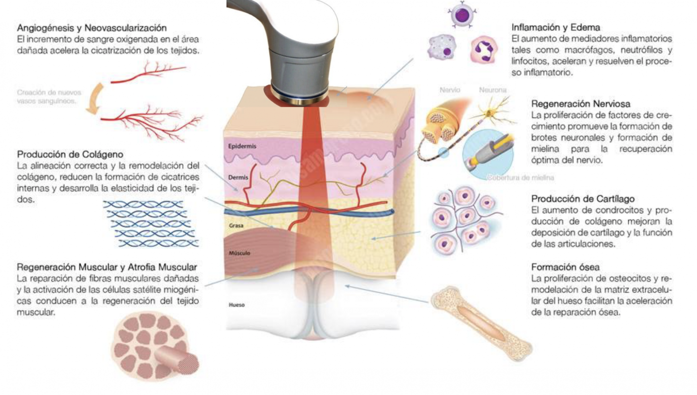 Fisioterapia Laser | Algología Laser - LasersLux USA